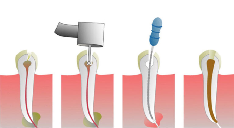 Lečenje kanala korena - endodoncija - Central dental & aesthetics